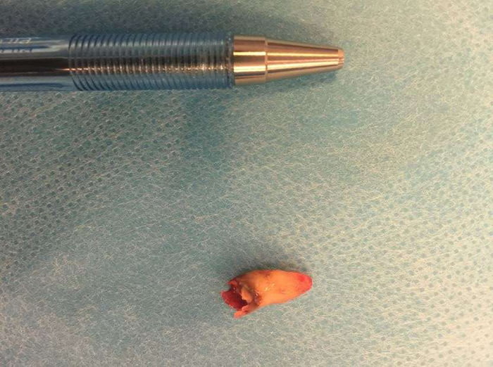 Man's Blocked Nose Was Caused By A Tooth Growing In His Nostril - 9GAG