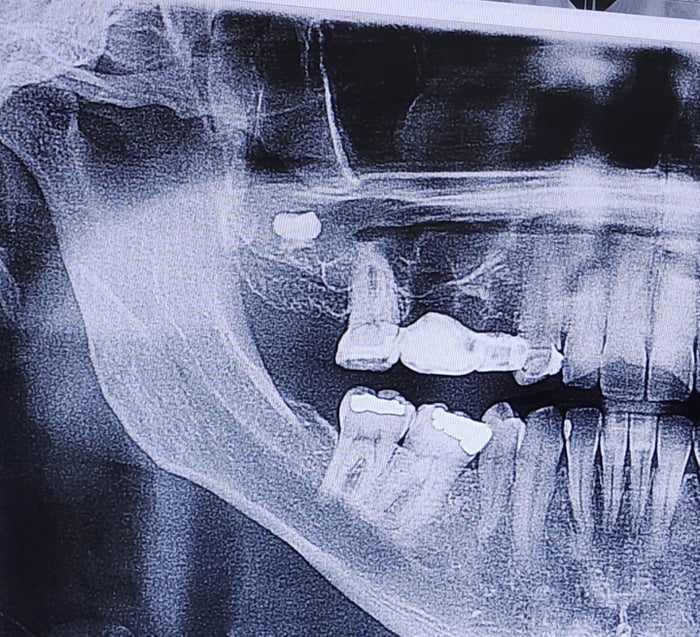 Tooth fell into sinus cavity during extraction. - 9GAG