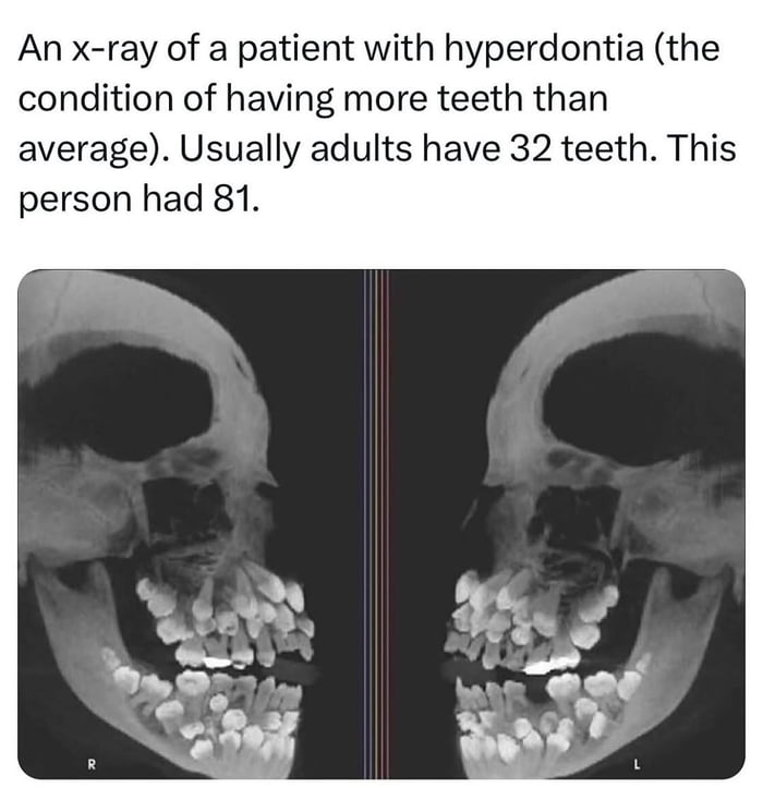 An x-ray showing the effects of hyperdontia, where one person had 81 teeth. - 9GAG