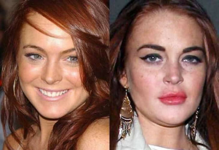 Startling Before-And-After Photos Of Cosmetic Surgery - 9GAG