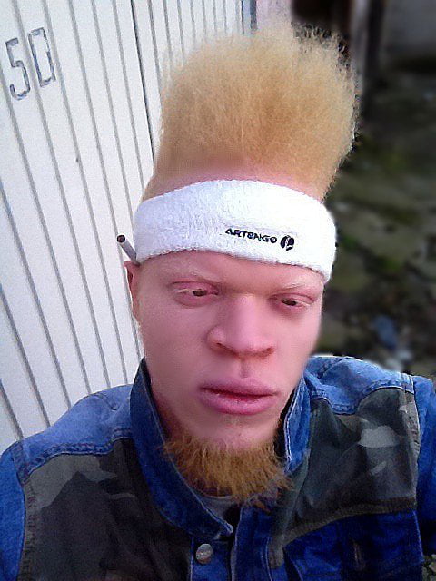 For those who wanted to see a black ginger albino person this is ...