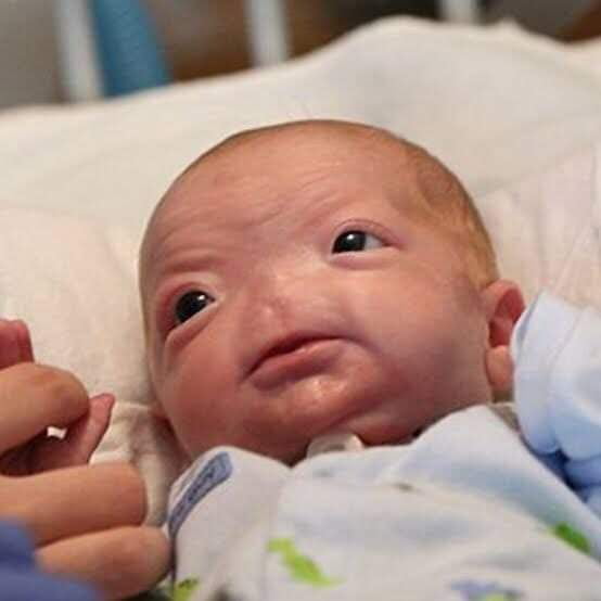 A baby born without nostrils. Arrhinia is a rare congenital anomaly ...