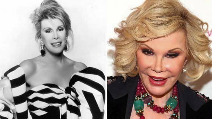 Startling Before-And-After Photos Of Cosmetic Surgery - 9GAG