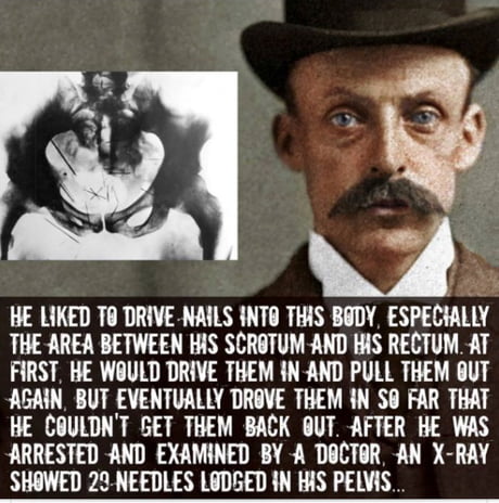 albert fish needles Cocaine originated - ISBAGUS