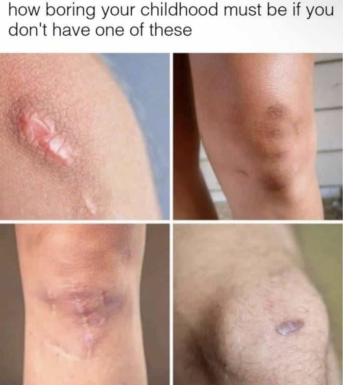 Childhood scars are badges of honor, telling tales of adventures and misadventures. - 9GAG