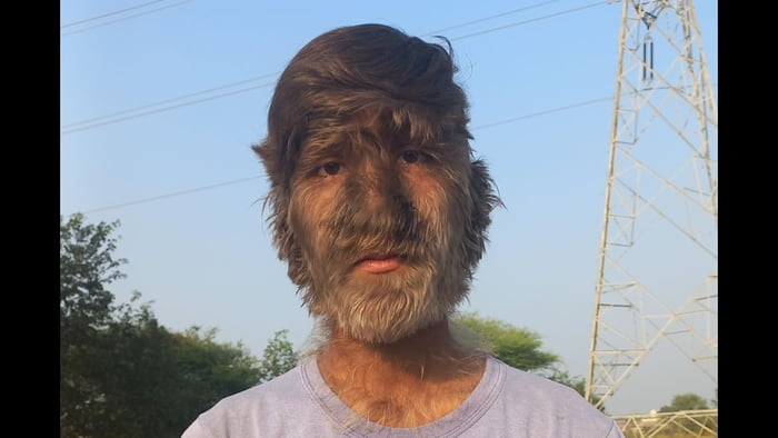 A teenager from Madhya Pradesh, India has an ultra rare condition ...