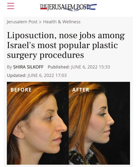 Rhinoplasty Memes