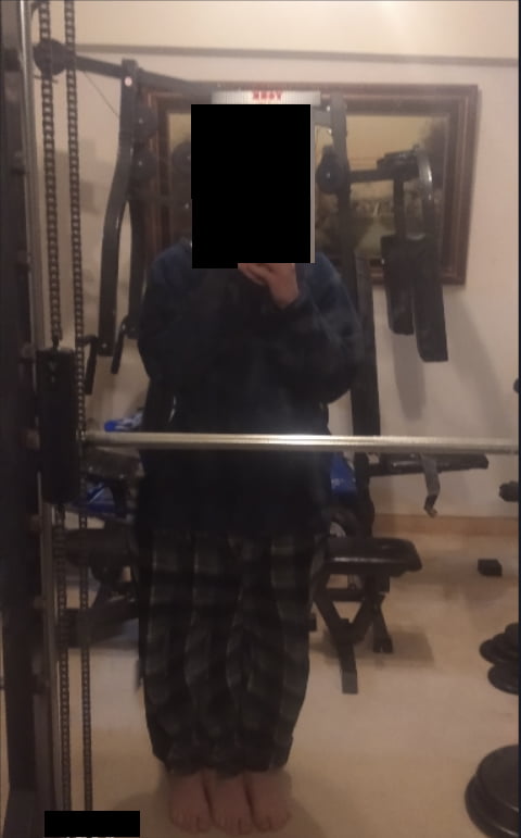 A rare case of tripodia,a genetic mutation that makes the person to be ...