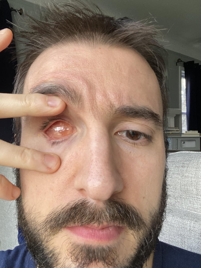 What an eye socket looks like before it’s fitted with a prosthetic ...