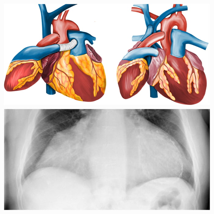 Heterotrophic Heart Transplant: Two hearts beating together - 9GAG