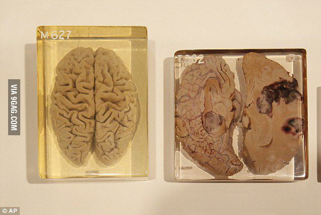Albert Einstein’s well preserved brain at mutter museum. - 9GAG