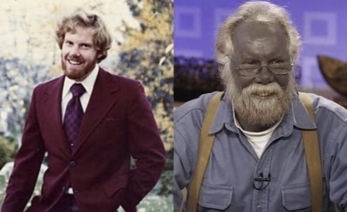 This man skin turned blue after drinking colloidal silver for over a ...