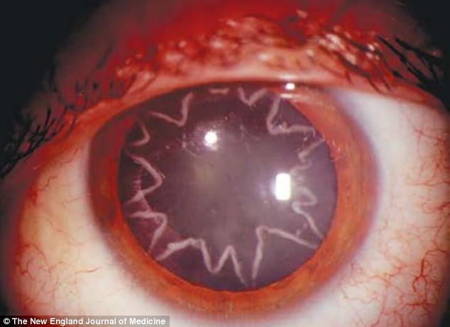 A star-shaped cataract that formed in an electrician's eye after being ...