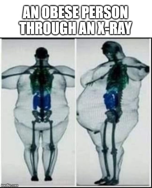 This is what an obese person looks like through an X-RAY - 9GAG