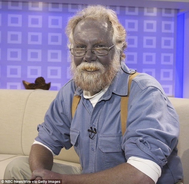 Paul Karason, turned permanently blue after using colloidal silver, a ...