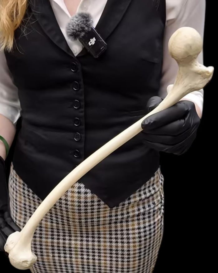 Exploring the impact of polio on bone structure. - 9GAG