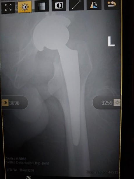 Best Funny hip replacement Memes - 9GAG
