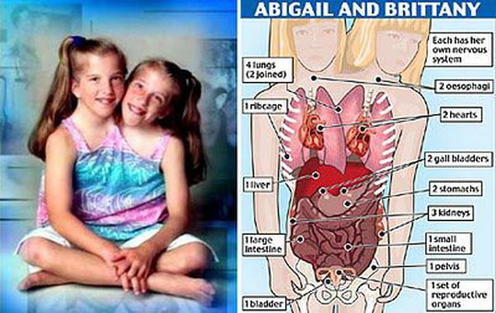 The anatomy of conjoined twins Brittany and Abby - 9GAG